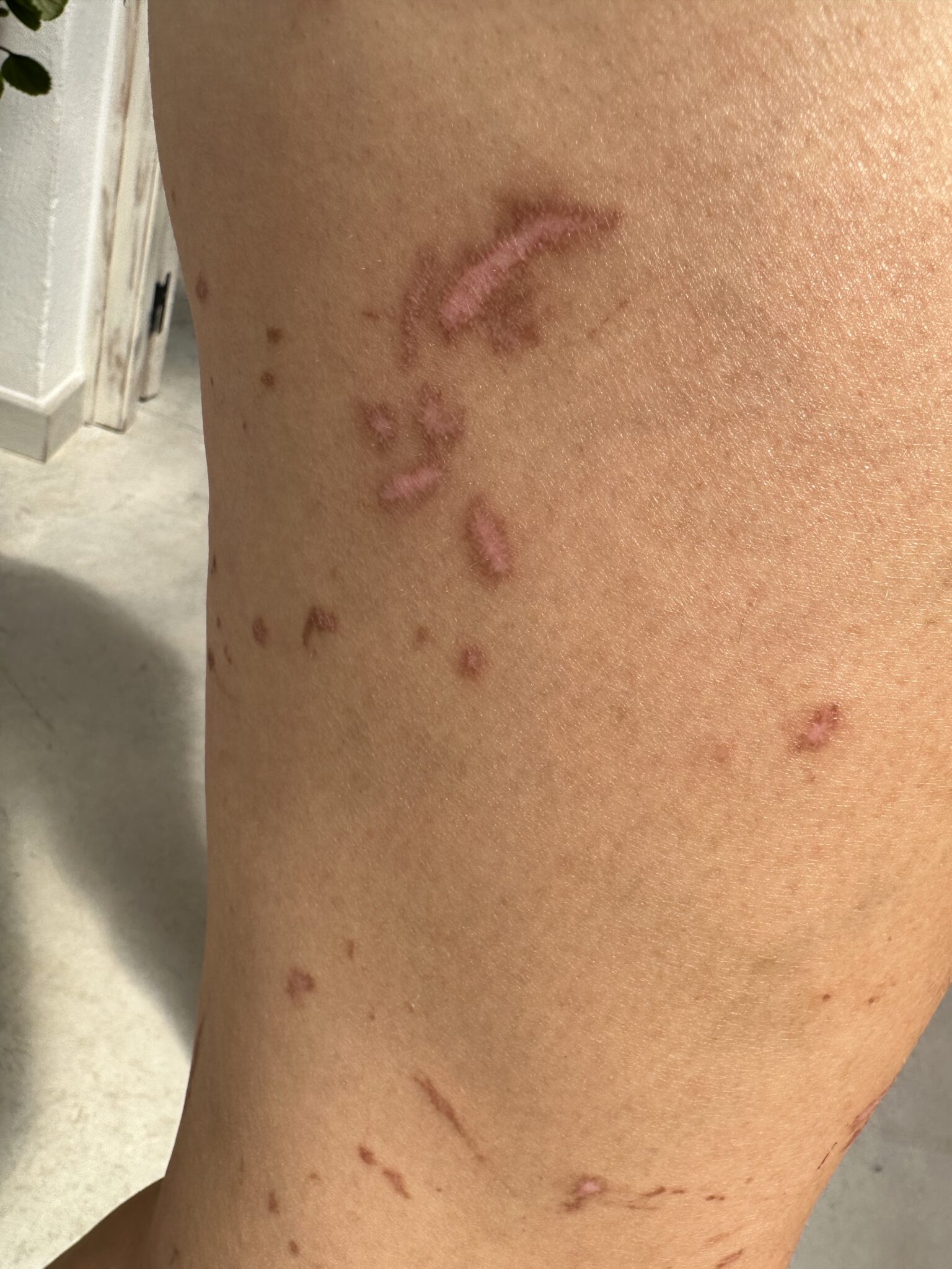 Fitofotodermatitis, plantas que la causan. - Serjardineros